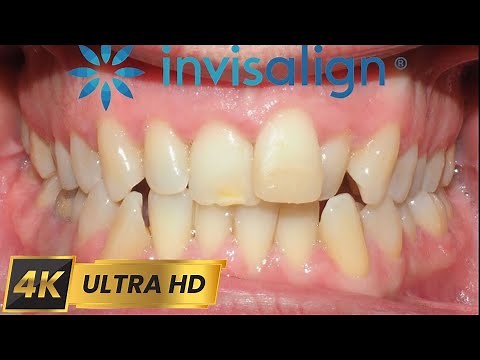 INVISALIGN treatment for 10 MONTHS! 4k time-lapse.