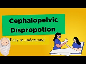 Cephalopelvic Disproportion (CPD) Causes, Signs, Diagnosis & Management #nursinglectures#obstretics