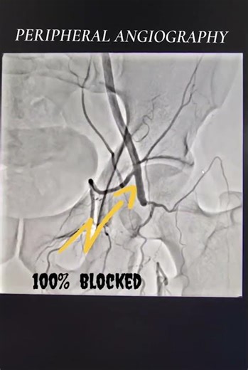 peripheral artery angiography 🦵🏻#medical #educationalvideos #shortvideo #youtubeshorts #shorts