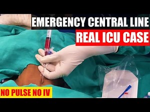 Central Line Insertion (CVC) in Internal Jugular Vein – Step-by-Step with Ultrasound