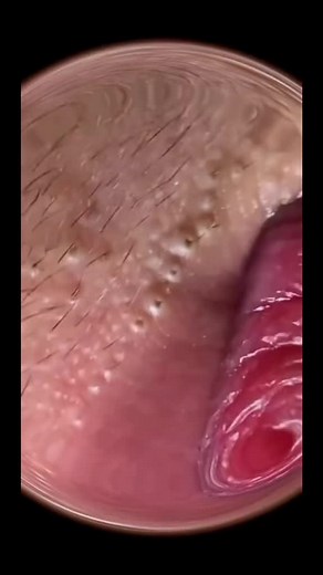 Big pimple blackhead removal #acne #pimple #blackhead #extractions #satisfying