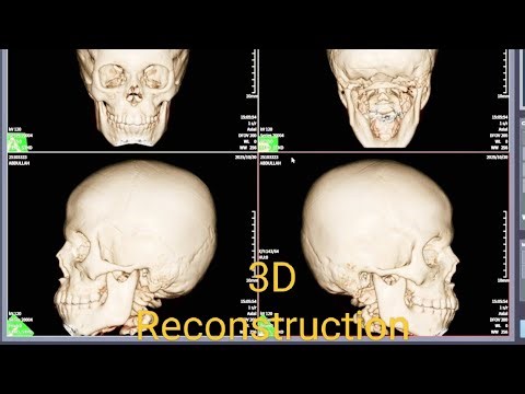 CT Scan Of Brain With Bone Window & 3D Reconstruction
