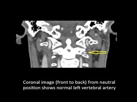 Vertebrobasilar Artery Syndrome | Bowhunters Syndrome | Colorado Spine Surgeon