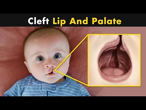 What Causes Cleft Lip And Cleft Palate? | Symptoms, Causes And Treatment