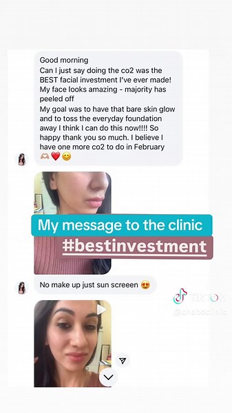 Skincare by Chebo Clinic (@cheboclinic) - Say Goodbye to Dark Spots with CO2 Laser Treatments