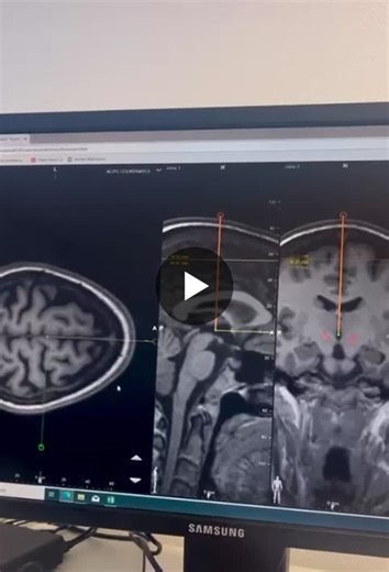 Is awake, open-brain surgery truly necessary to accurately identify the subthalamic nucleus for the management of Parkinson’s disease symptoms? 🧠 As part of my internship in clinical neurosurgery… | Julia San Martin