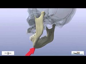 fractures of the mandibular condyle