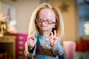 Little girl with rapid aging disease is an internet superstar