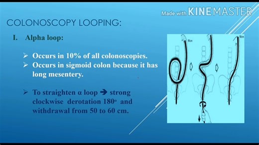 Colonoscopic loops/肠镜成袢