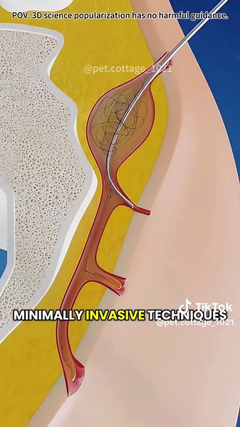 Pilonidal Cyst Treatment (3D Animation) #cyst #treatment #technique #hair #3danimation