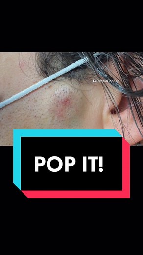 POP It! Even if it’s an amaryllis bulb! 🤣#drpimplepopper #SLMDskincare