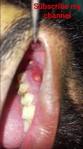dantal abscesses treatment/teeth abscess/ tooth full treatment in description #dentist