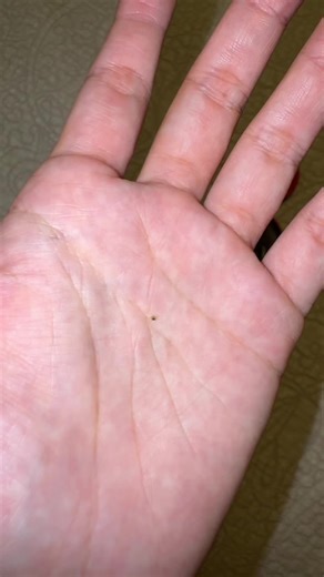 PRID drawing salve works like magic! #priddrawingsalve #prid #splinterremoval #splinter #ingrownhairs #ingrown #pimplepopping