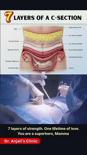 7 Layers of a C-Section: What Actually Happens?