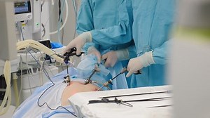 Laparoscopic cholecystectomy instrument. Real Surgery, abdominal incision, working with surgical laparoscopy instruments. Doctor hands in sterile gloves holding trocar for laparoscopy procedure. 4 k