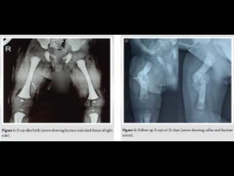 Femur Bone fracture in Newborns and Children