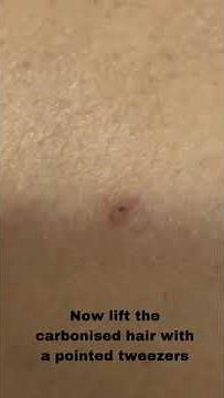 How to remove ingrown hairs