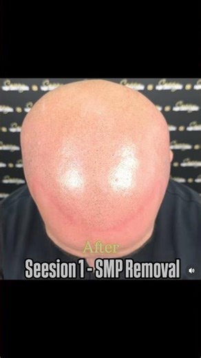 Botched SMP Removal | Laser Scalp Micropigmentation Removal Session 1🔥