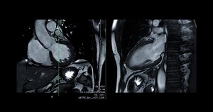 clip-1083252298-mri-heart-cardiac--magnetic-resonance-imaging