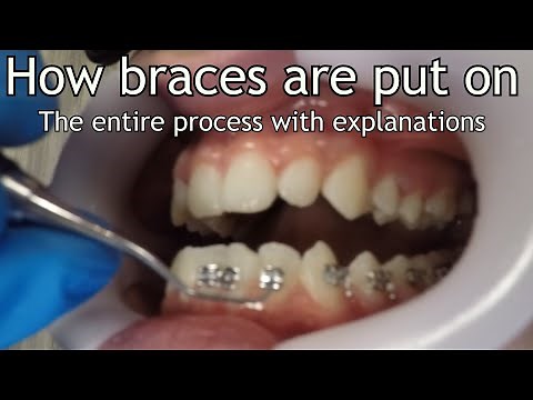 Watch The Amazing Process Of Getting Braces Step By Step!