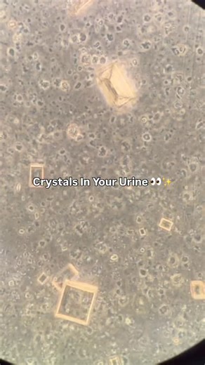 Have you ever seen coffin-shaped crystals in your urine? ✨⚰️ When you pee in a cup at the doctor’s office, your urine doesn’t just get tested by a machine. It actually gets looked at under a microscope to see what’s floating around in it. Sometimes minerals in the urine clump together and form crystals, and that’s exactly what you’re seeing here. These are called triple phosphate crystals, and they form when urine becomes more alkaline. Now for the science. These are also known as struvite cryst