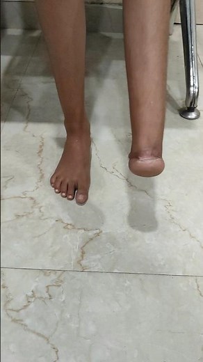 short stump prosthetic leg