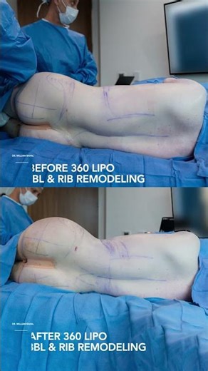 Gender Affirming Surgery - 360 Lipo & BBL with Rib Remodeling! Before & After Results!