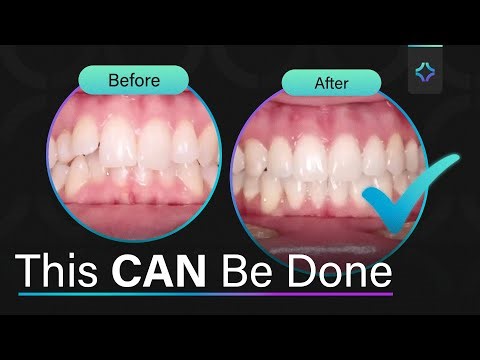 Sequential Distalization in Action: From Retroclined Anteriors to Class I - Ep. 22