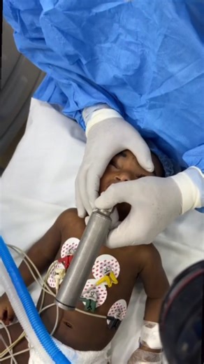 Uni Medical care on Instagram: "Endotracheal Intubation in Children Endotracheal intubation is a critical medical procedure necessary to maintain an open airway in children, especially in emergency situations or during surgical anesthesia. The intubation technique in children differs from that in adults due to anatomical differences, as the pediatric airway is smaller, narrower, and less rigid, making it more prone to collapse or swelling when irritated. Therefore, selecting the appropriate endo