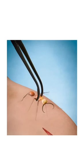 Ꭷᴍ Ꮆᴀ፝፝֟ᴜƊ on Instagram: "How To Catch A Baboon 😨. 🏜️⏳ A hiker stuck in quicksand faces a deadly myth — struggling to get out only pulls him deeper. Physics dictates that the human body is actually less dense than the sand-water mixture. If he fights, the vacuum effect traps him; but if he leans back and lays still, he floats like a log. Panic buries the body, but trusting density saves it 🛑🧘‍♂️. 🖨️🩸 In a futuristic medical twist, doctors are now “printing” human skin to save burn victims.