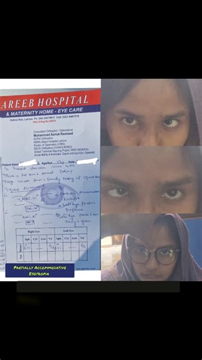 Dr. Muhammad Asmat Rasheed on Instagram: "This is a case of partially accommodative esotropia, as the amount of deviation reduced after prescribing +6.25 D hyperopic correction, though some residual esodeviation remained. Early eye examination and timely spectacle correction in children are essential to prevent amblyopia and ensure proper visual development. Consultation with a squint specialist is crucial for timely and accurate decision-making in the management of strabismus. 👁️👓 Dr. Muhamma