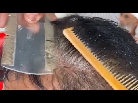 Best dandruff flakes scratching off video asmr