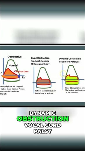 Airway Obstruction: Vocal Cord Palsy Explained #shorts