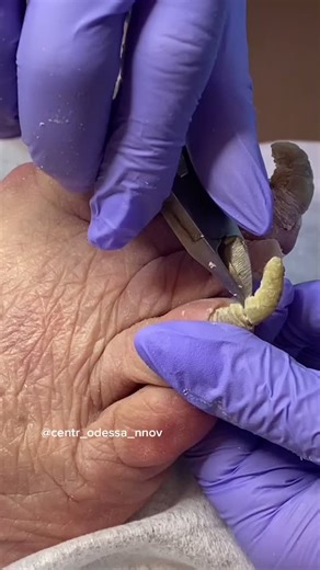 Бабушке не стригли ногти год! #подолог #подология #онихогрифоз #подологнижнийновгород