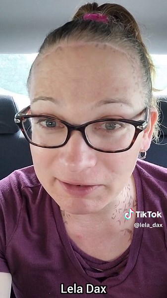 Atualização Após 3 Meses da Cirurgia de Feminização Vocal