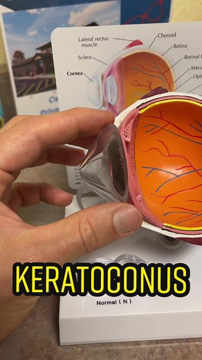 Understanding Keratoconus: Causes, Symptoms, and Treatment Options