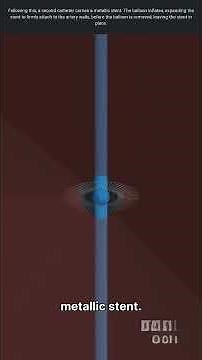 Coronary Angioplasty