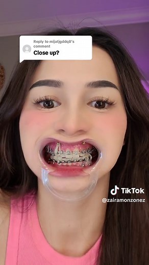 Zaira Monzon Braces: TADS, Overbite, and Gummysmile Solutions