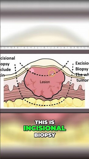 Breast tumors: Incisional vs. Excisional Biopsy Medicine in 3 Minutes #shorts