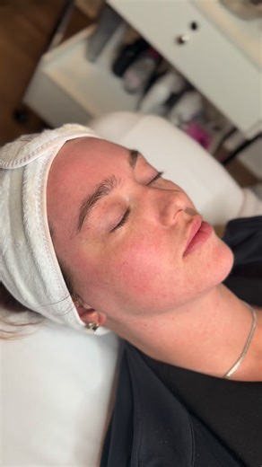 From dull to dewy ✨ Comment GLOW to learn about the Dermaplane Pro Facial Looking to book? Call 910-477-9038 📞 or go to liveoakmedspa.com 💻 • • • #liveoakmedspa #medspa #southportnc #oakislandnc #dermaplaneprofacial | Live Oak Med Spa