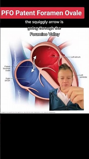 PFO? What is a patient foramen ovale? How do you fix PFO?