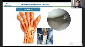 Wrist Arthroscopy: Step by Step