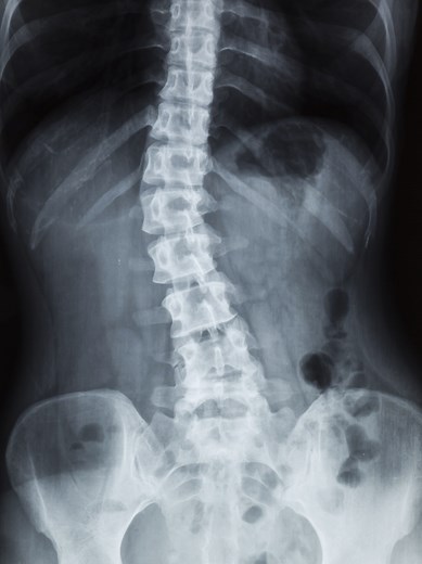 The Spiritual Cause of Scoliosis