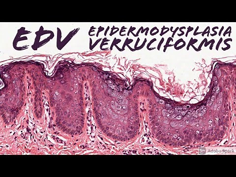 Epidermodysplasia Verruciformis (EDV): 5-Minute Pathology Pearls