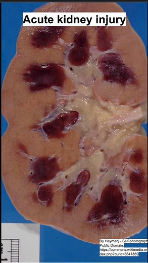 Acute kidney injury - youtube.com/@MedLecturesMadeEasy