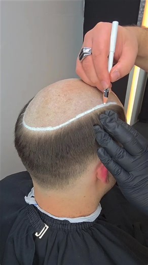 Understanding Hair Replacement Systems for Confidence