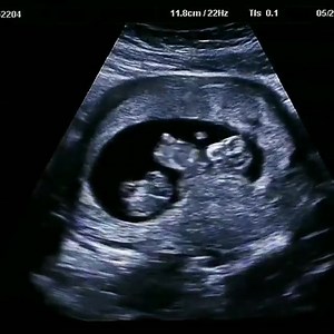 Twin lovers This is for you This is how your scan will look like Best wishes Don't forget for a successful pregnancy you need take care of it. Join our Pregnancy class to learn more 0242281957. Its 100 cedis to join Buy Sally Tipwvia mobile money https://play.google.com/store/apps/details?id=com.readerapp.ecommerce Available on Amazon... https://www.amazon.com/dp/B08JBY73D2 Also available on https://okadabooks.com/book/about/sally_s_tips_for_expectant_mums/37081 Video credit @eobstetricsandgynec