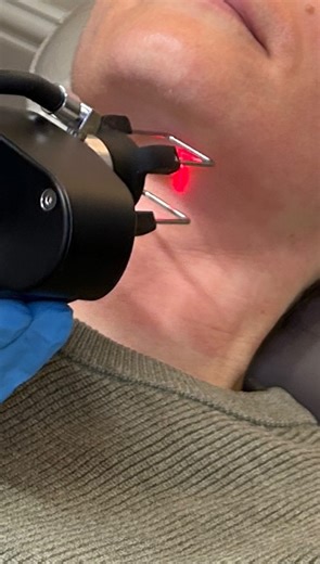 COOLPEEL using the Smartxide Punto Deka laser. This is unique because the coolpeel technology allows powerful pulses of laser to be emitted, without creating excessive thermal energy. Ie a cooler laser. The individual laser beams you see are vaporising water in the epidermis to create these micro channels in the skin at a superficial depth. This allows the removal of the superficial layer of skin in a controlled environment and enabling new skin to come through. Overall resulting in smooth, even