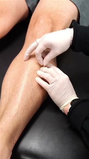 Dry Needling for Runners - Shin Splints