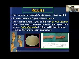 AAHS/TSSH/HKSSH Webinar Tips and Tricks for CMC Arthritis: Arthroscopy, Trapeziectomy, Denervation